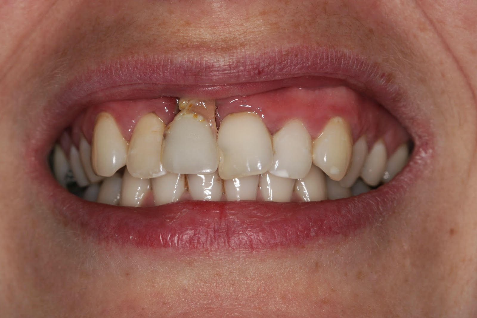 Implanty stomatologiczne - Brzyski Dental Care Kraków | Dentysta ...
